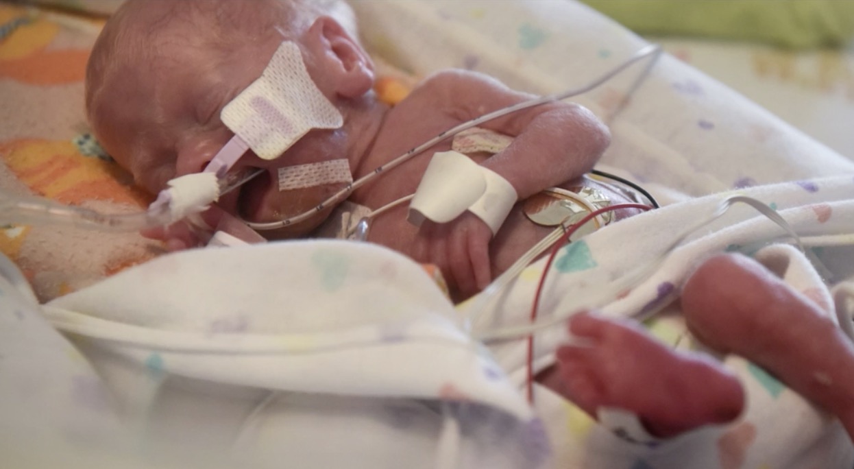 Meet the 1-Pound Miracle Baby Who is Defying the Odds and Thriving ...
